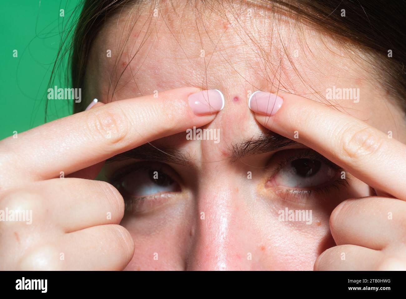 Acne. Close up acne pimple on female skin. Dermatology, puberty woman ...