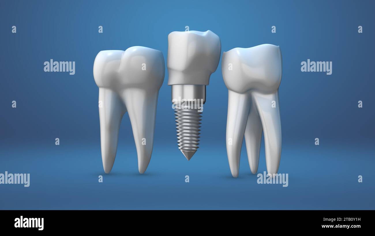 Tooth implant and crown installation process Stock Photo - Alamy