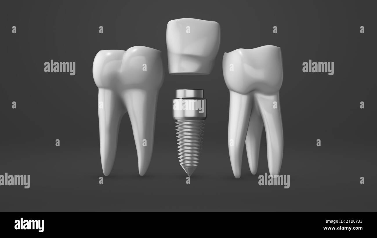 Tooth implant and crown installation process Stock Photo - Alamy