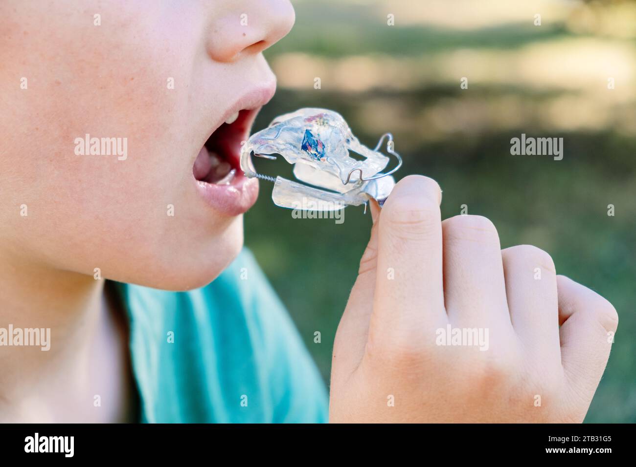 Correct the bite hi-res stock photography and images - Alamy