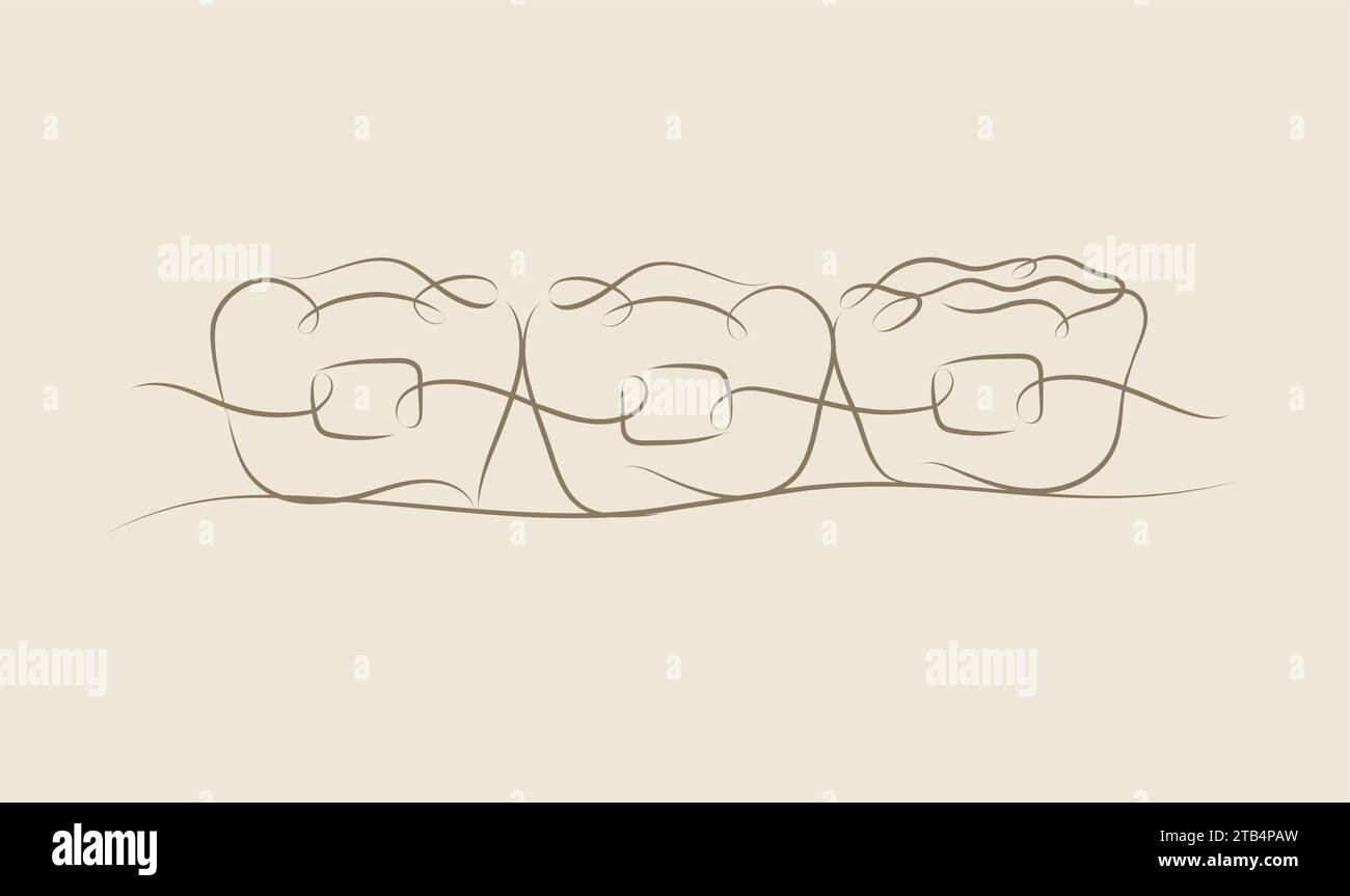 Teeth braces illustration drawing in linear style on beige color ...