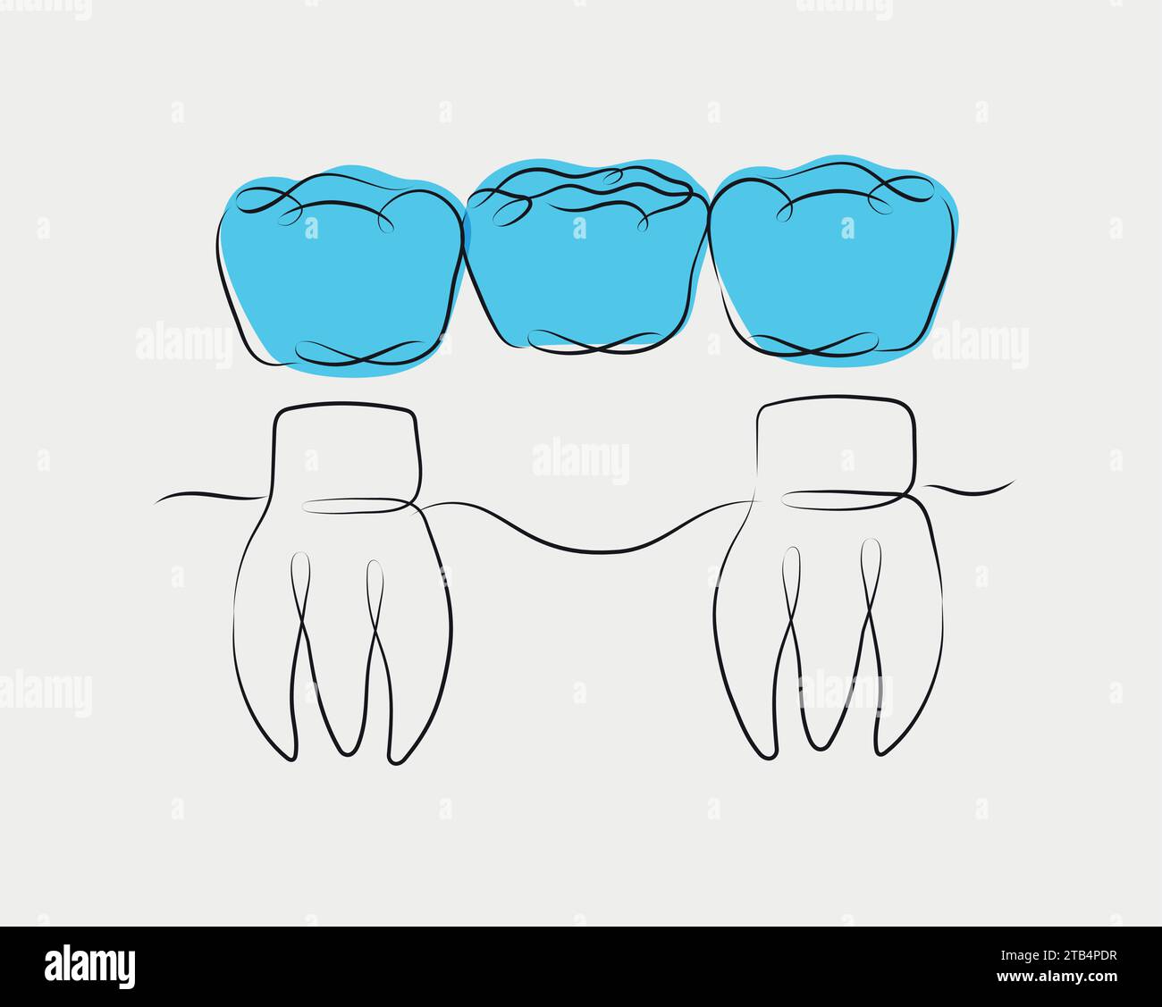 Teeth with crown bridge illustration drawing in linear style on white ...