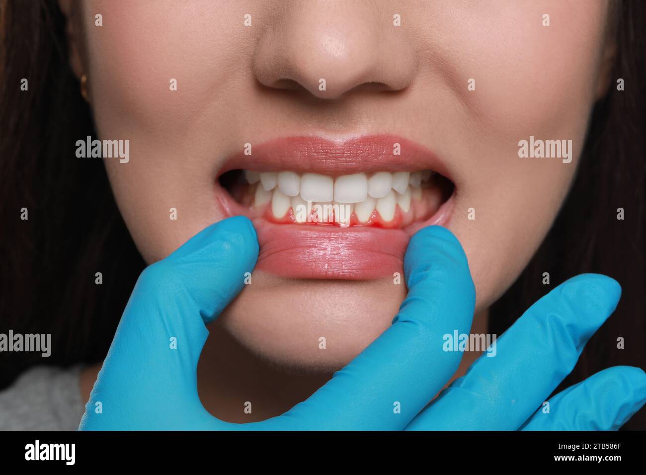 Doctor examining woman's inflamed gum, closeup. Oral cavity health ...