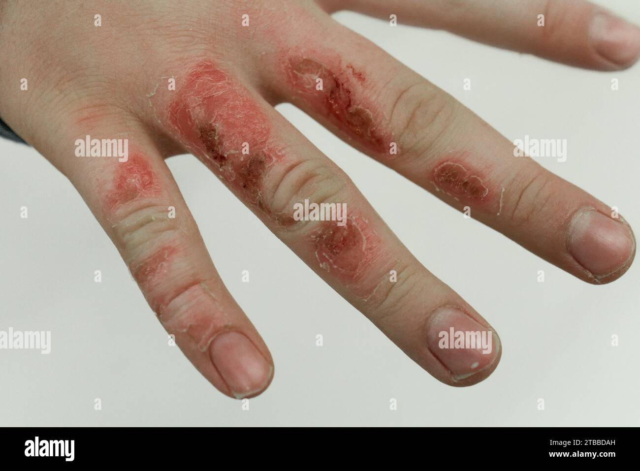 Wound of a child's hand with a thermal burn of the skin after boiling ...