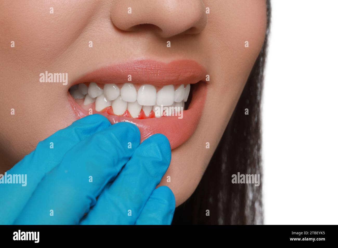 Doctor examining woman's inflamed gum on white background, closeup ...