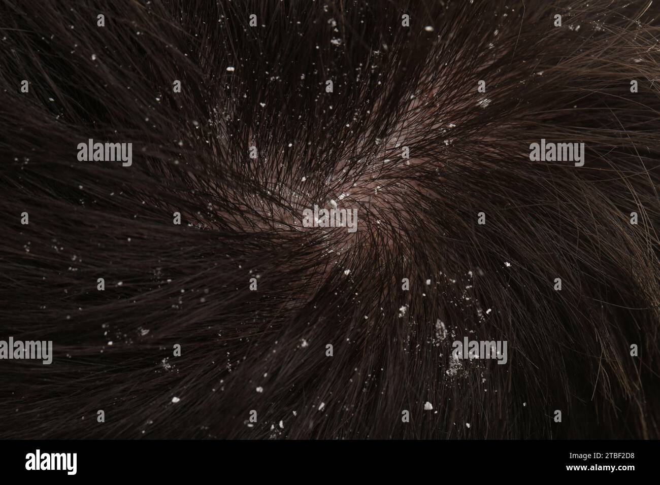 Dandruff prevention treatment hair hi-res stock photography and images ...