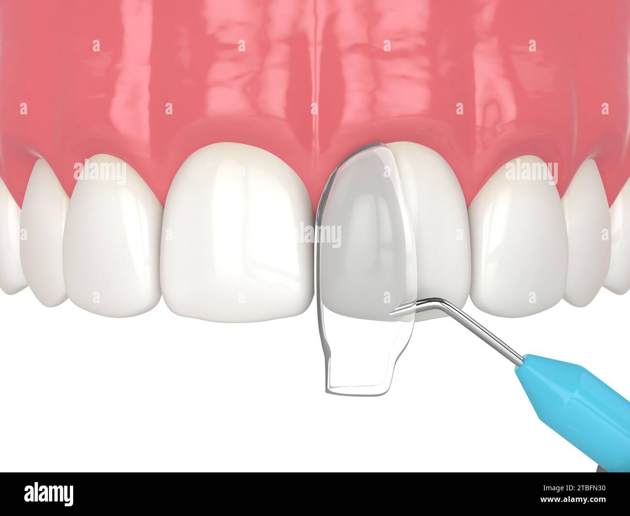 3d render of crooked tooth treatment using bonding procedure Stock ...