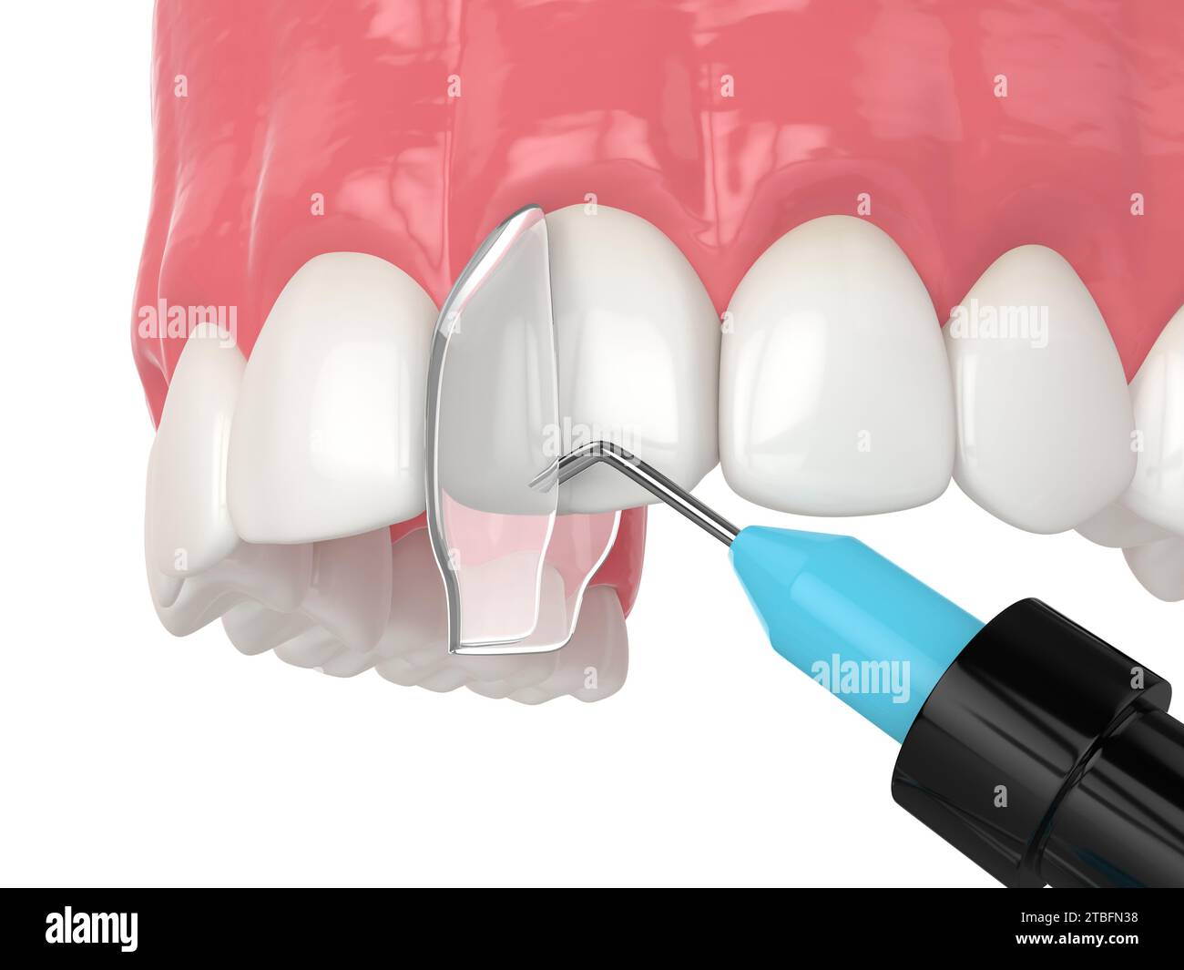 3d render of crooked tooth treatment using bonding procedure Stock ...