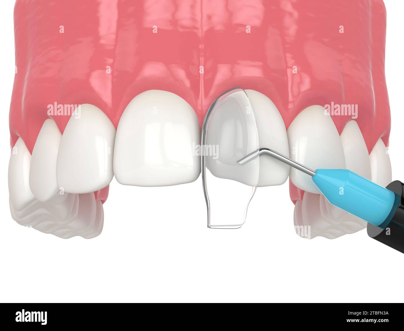 3d render of crooked tooth treatment using bonding procedure Stock ...