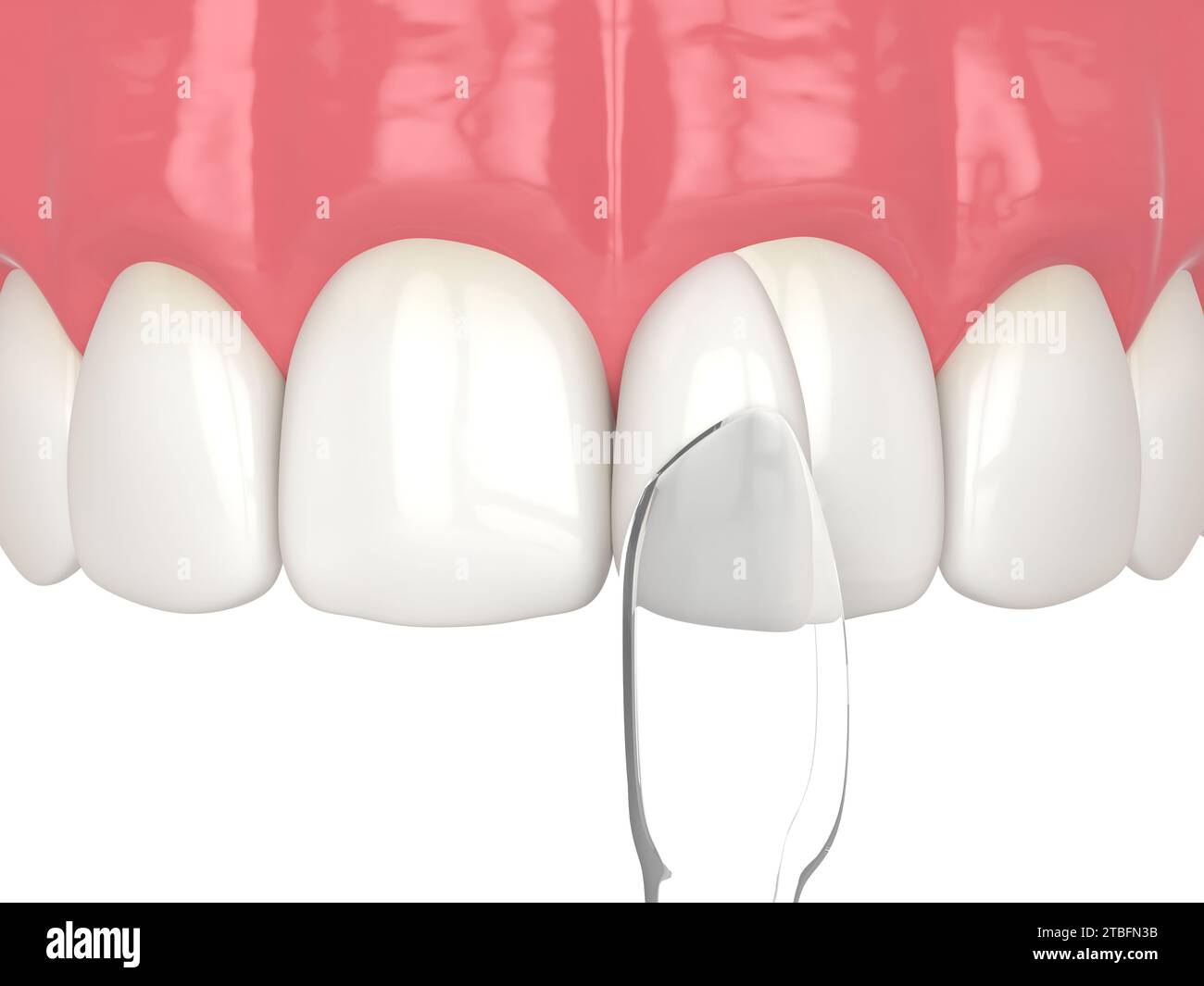 3d render of tooth reshaped by composite resin adm matrix over white ...