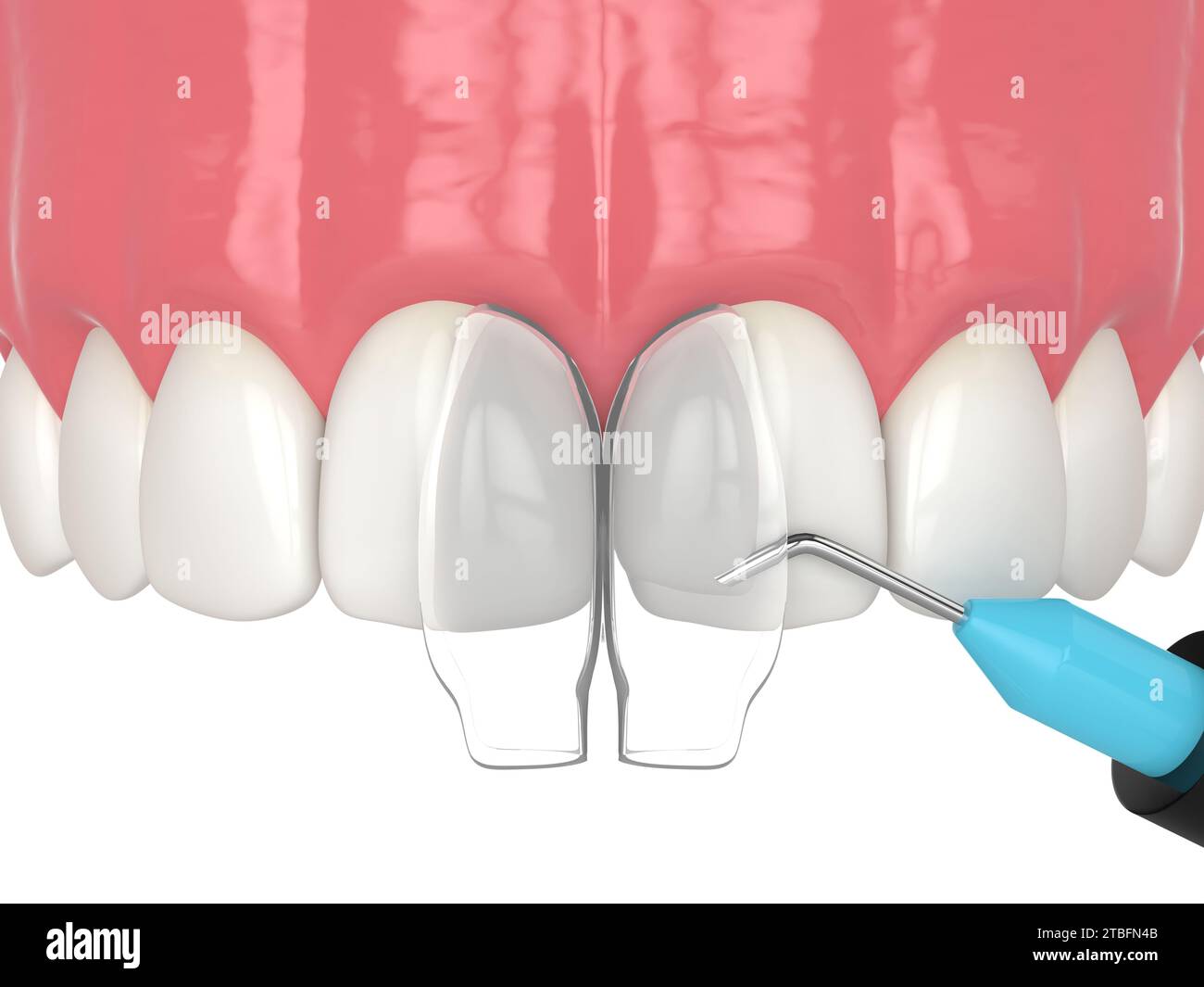 3d render of diastema closure using bonding procedure. Part 5. Applying ...