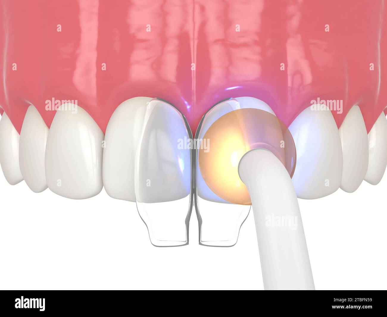 3d render of diastema closure using bonding procedure. Part 6 ...