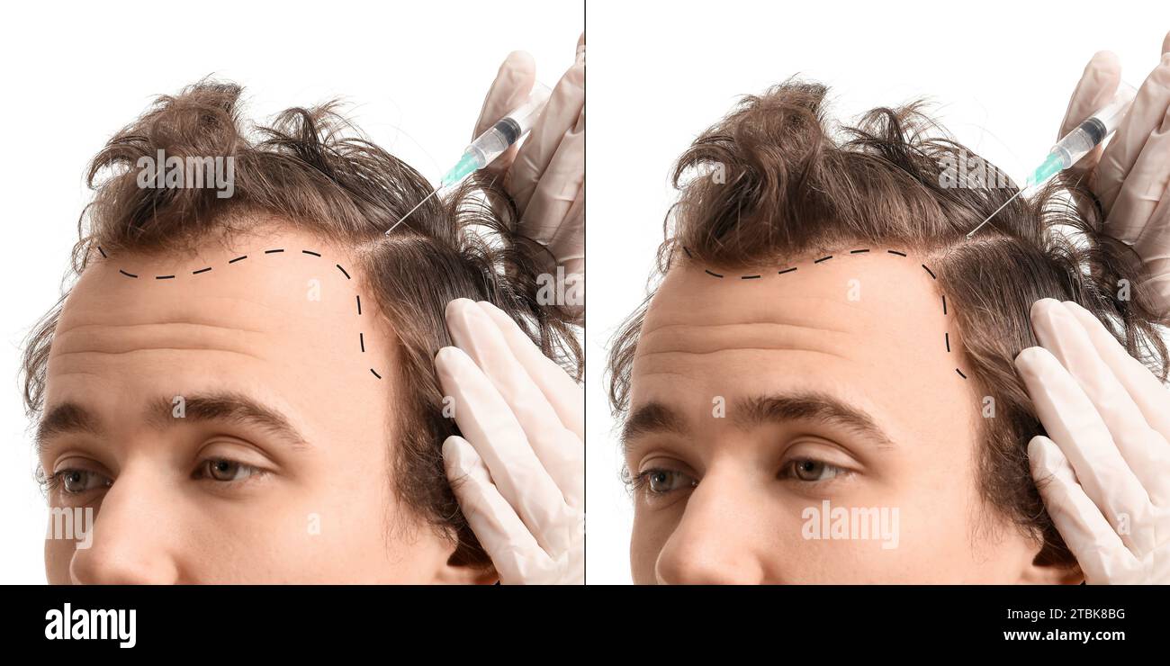 Hair injections hi-res stock photography and images - Alamy