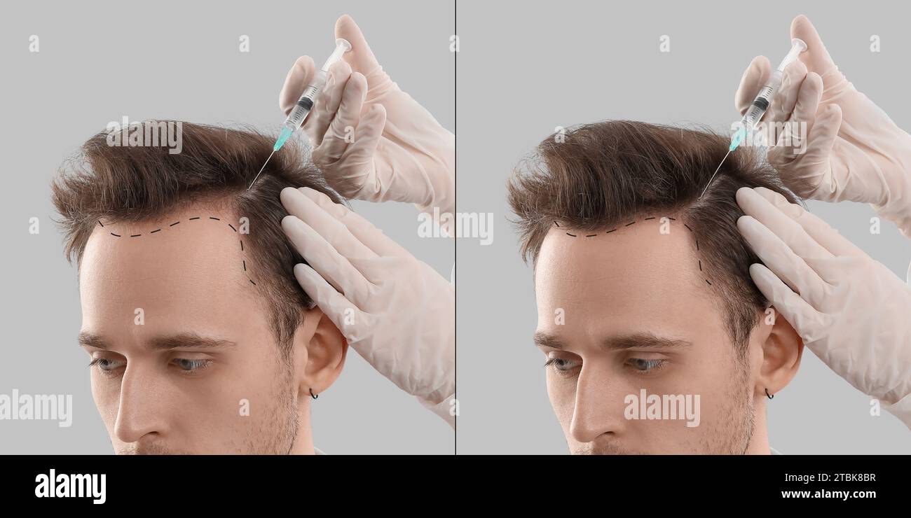 Young man before and after injections for hair loss treatment on grey ...