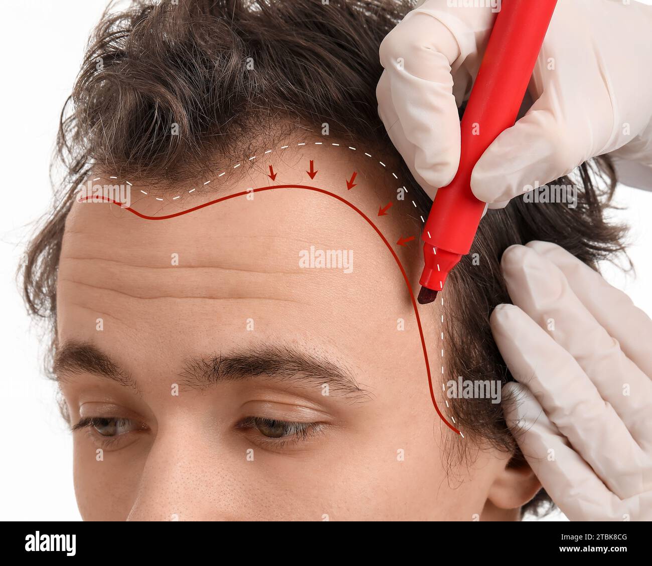 Skin of scalp hair follicles hi-res stock photography and images - Alamy