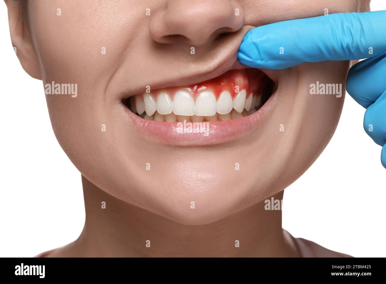 Doctor examining woman's inflamed gum on white background, closeup ...