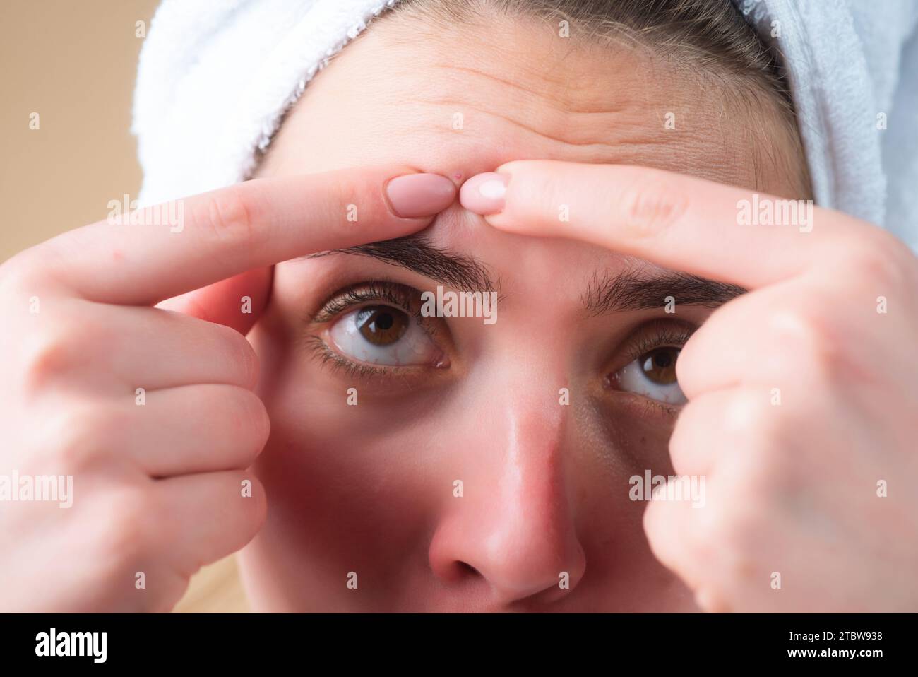 Acne. Close up acne pimple on female skin. Dermatology, puberty woman ...