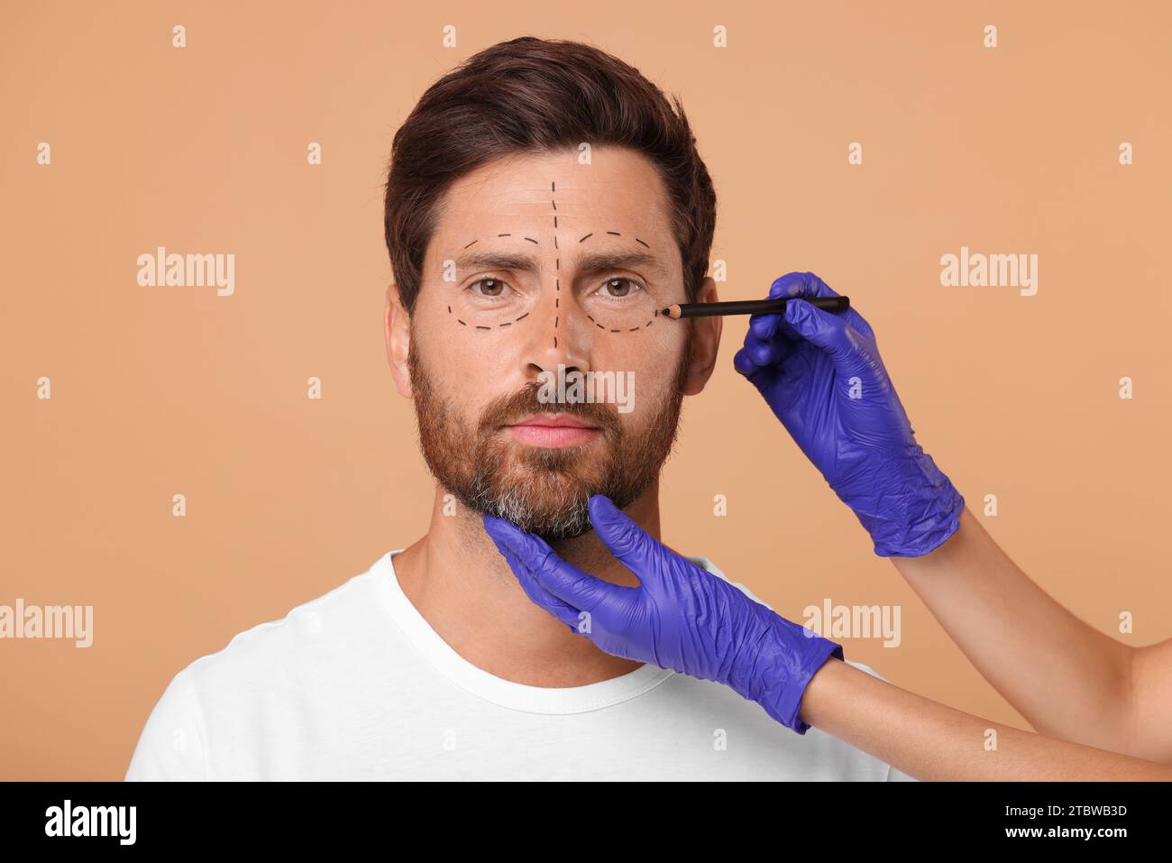 Doctor drawing marks on man's face for cosmetic surgery operation ...