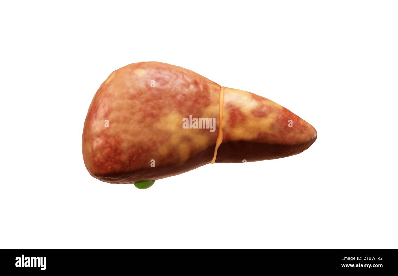 Liver organ with fatty liver state, 3d rendering. 3D illustration Stock ...