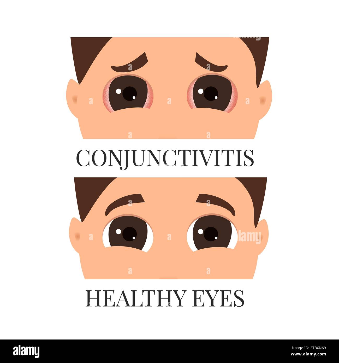 Conjunctivitis, conceptual illustration Stock Photo - Alamy