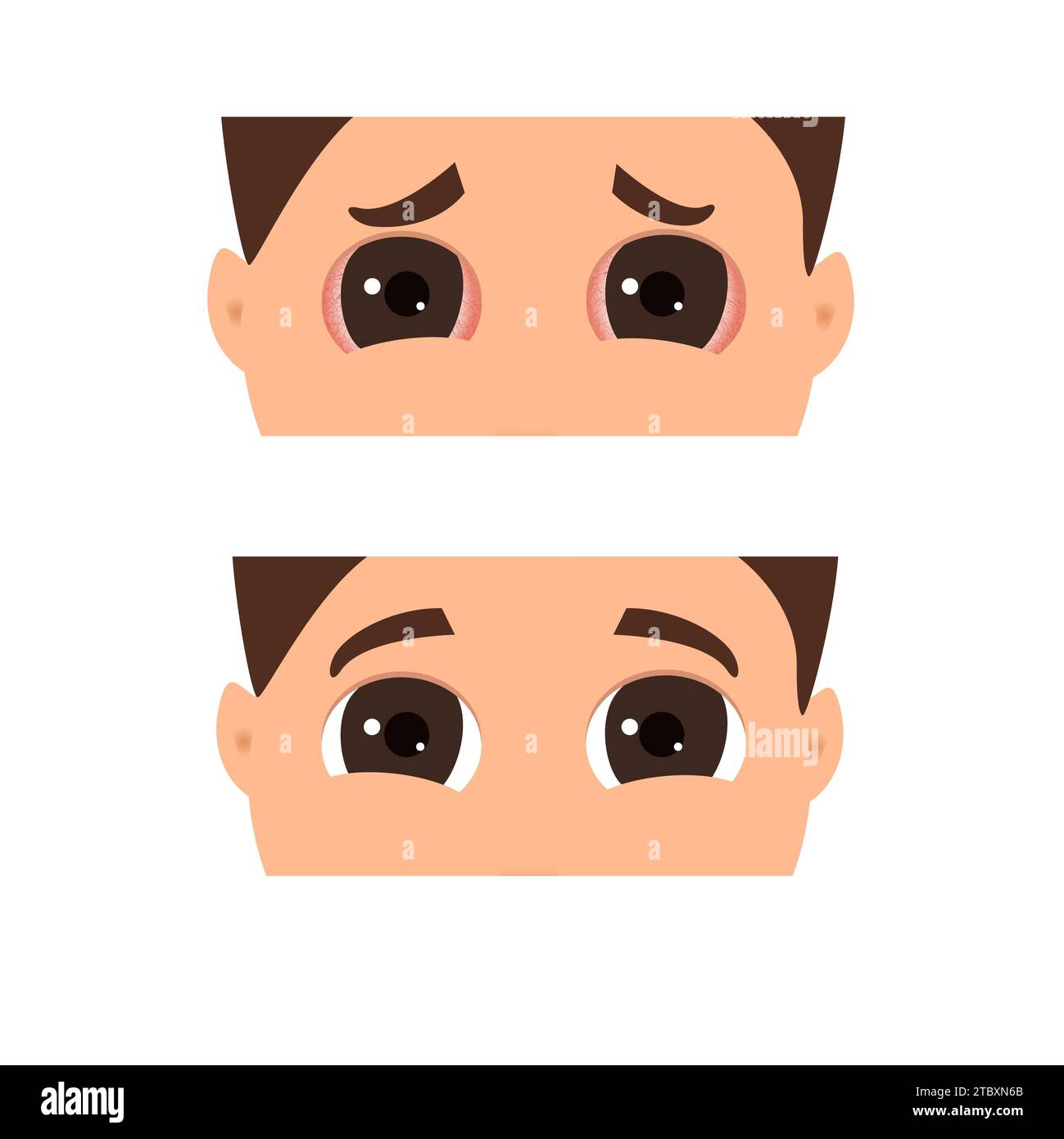 Viral conjunctivitis hi-res stock photography and images - Alamy