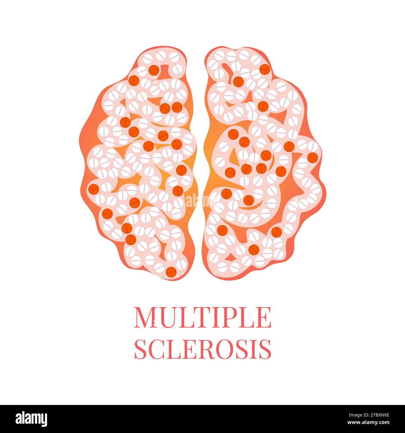 Multiple sclerosis demyelination myelin Cut Out Stock Images & Pictures ...