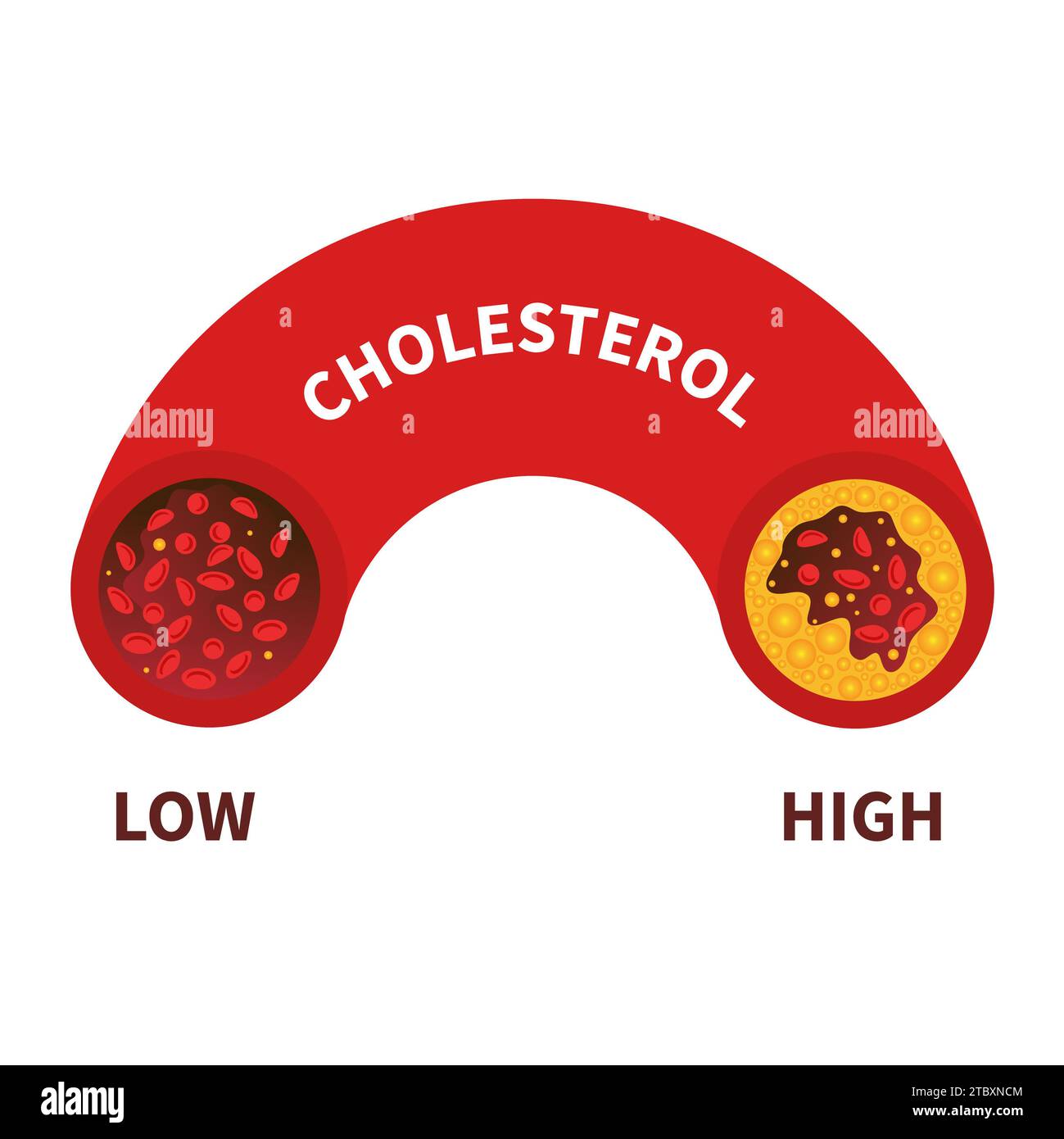 Atherosclerosis, conceptual illustration Stock Photo - Alamy Atherosclerosis, conceptual illustration Stock Photo - Alamy