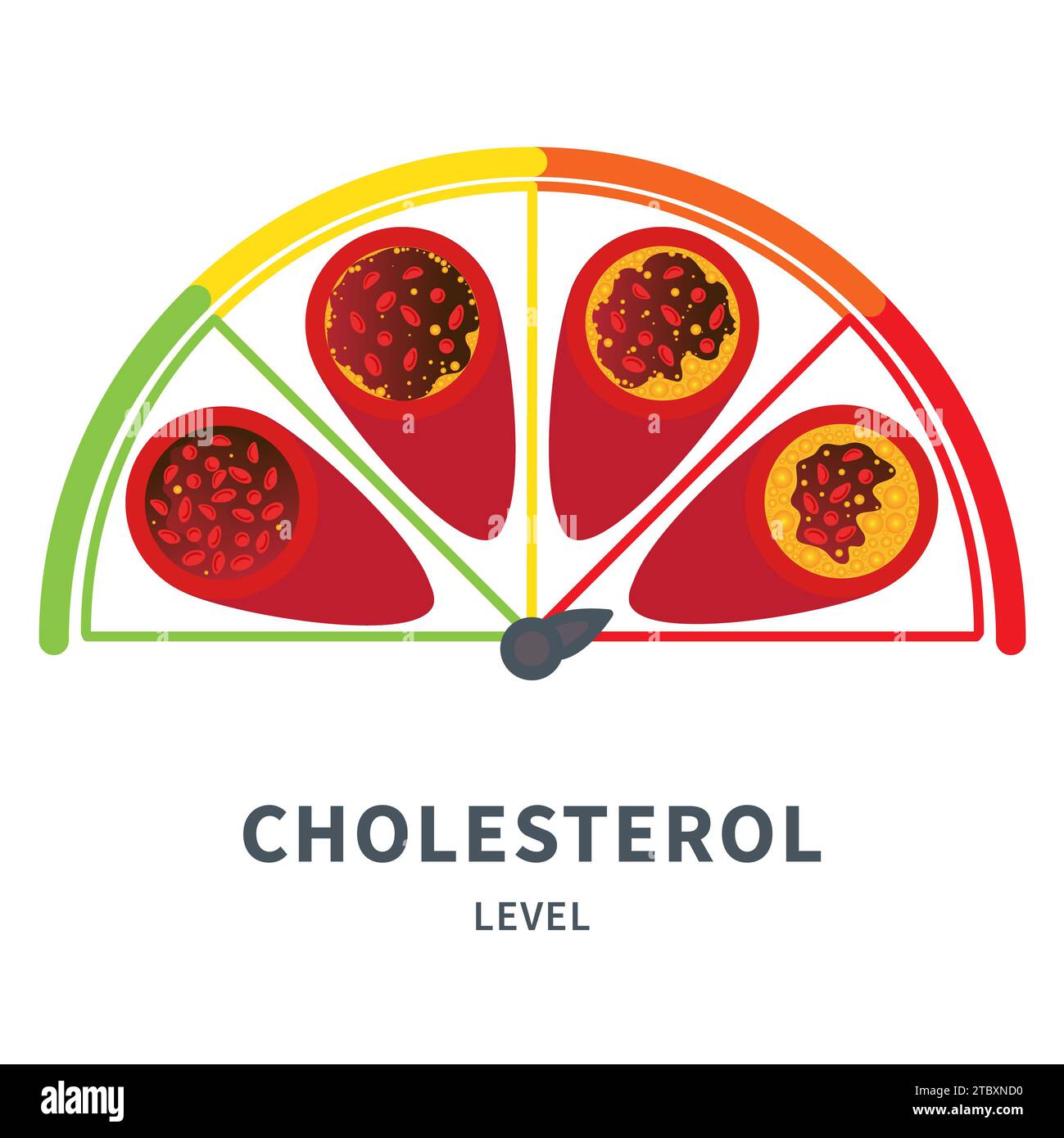 Atherosclerosis, conceptual illustration Stock Photo - Alamy Atherosclerosis, conceptual illustration Stock Photo - Alamy
