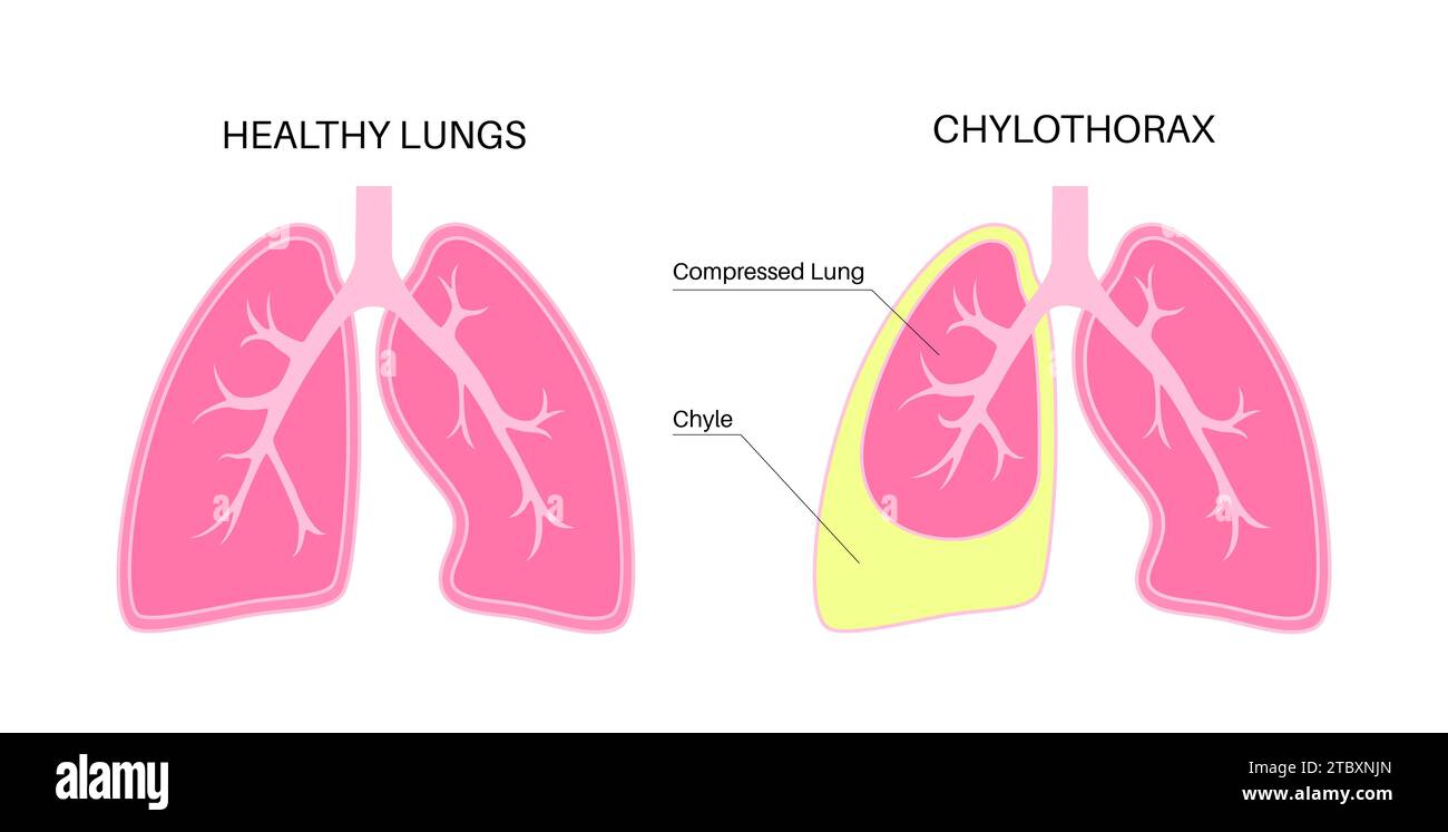 Chylothorax hi-res stock photography and images - Alamy