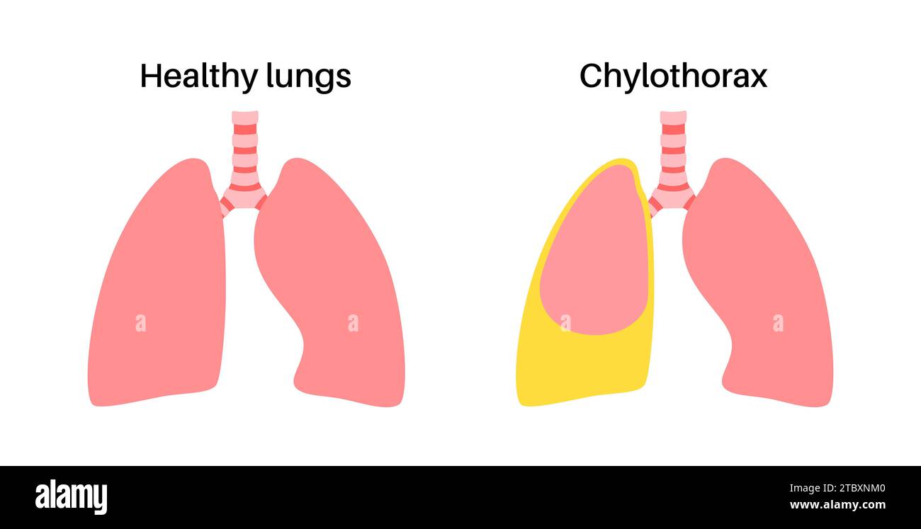 Chylothorax hi-res stock photography and images - Alamy