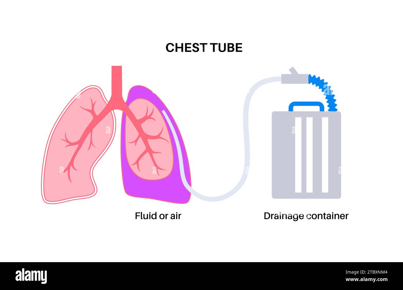Chest tube catheter, illustration Stock Photo - Alamy
