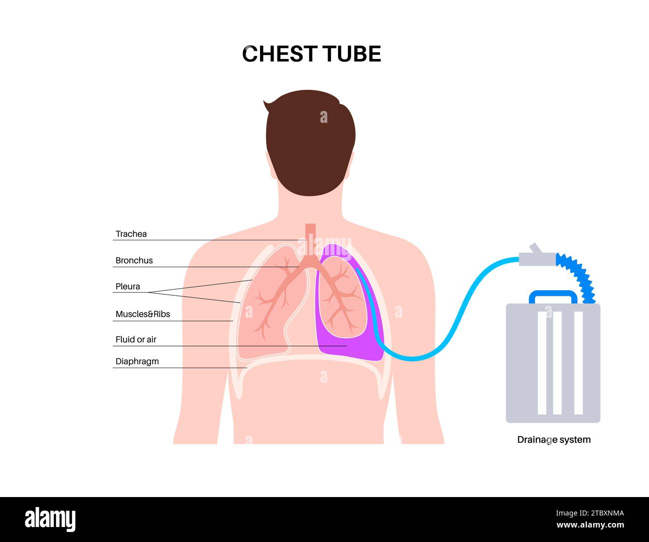 Chest tube catheter, illustration Stock Photo - Alamy