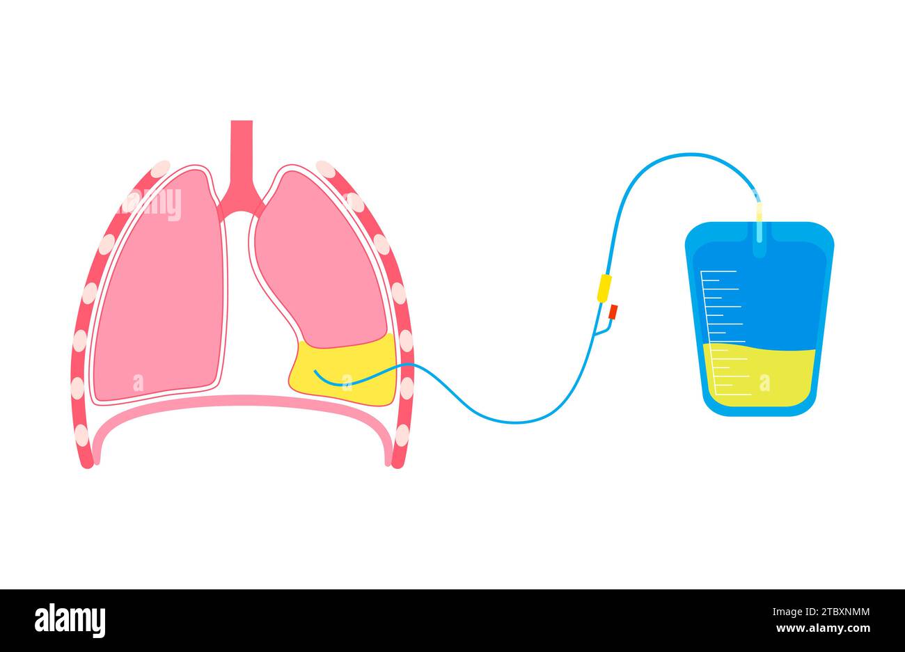Thoracentesis medical procedure, illustration Stock Photo - Alamy