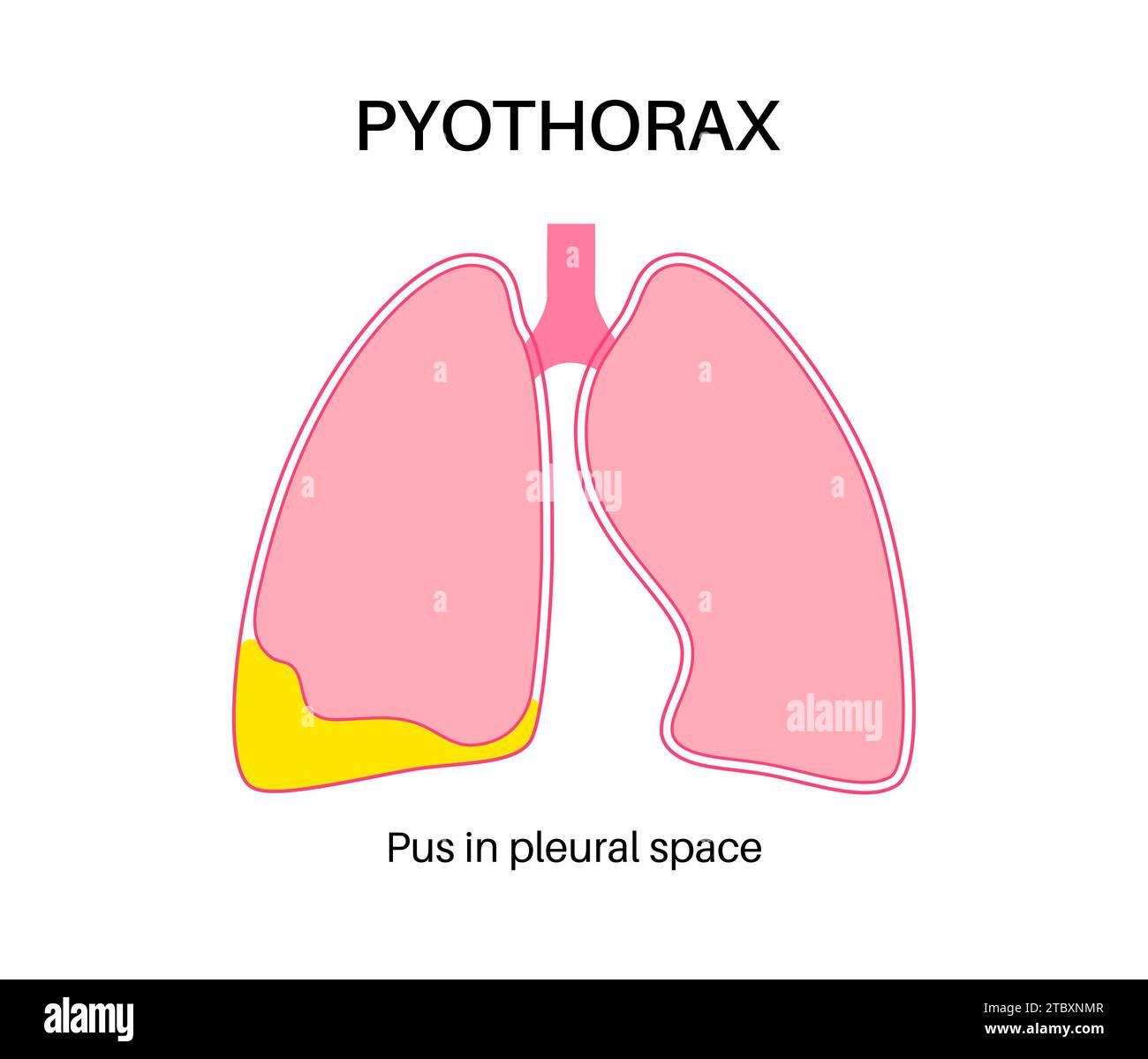 Pyothorax hi-res stock photography and images - Alamy