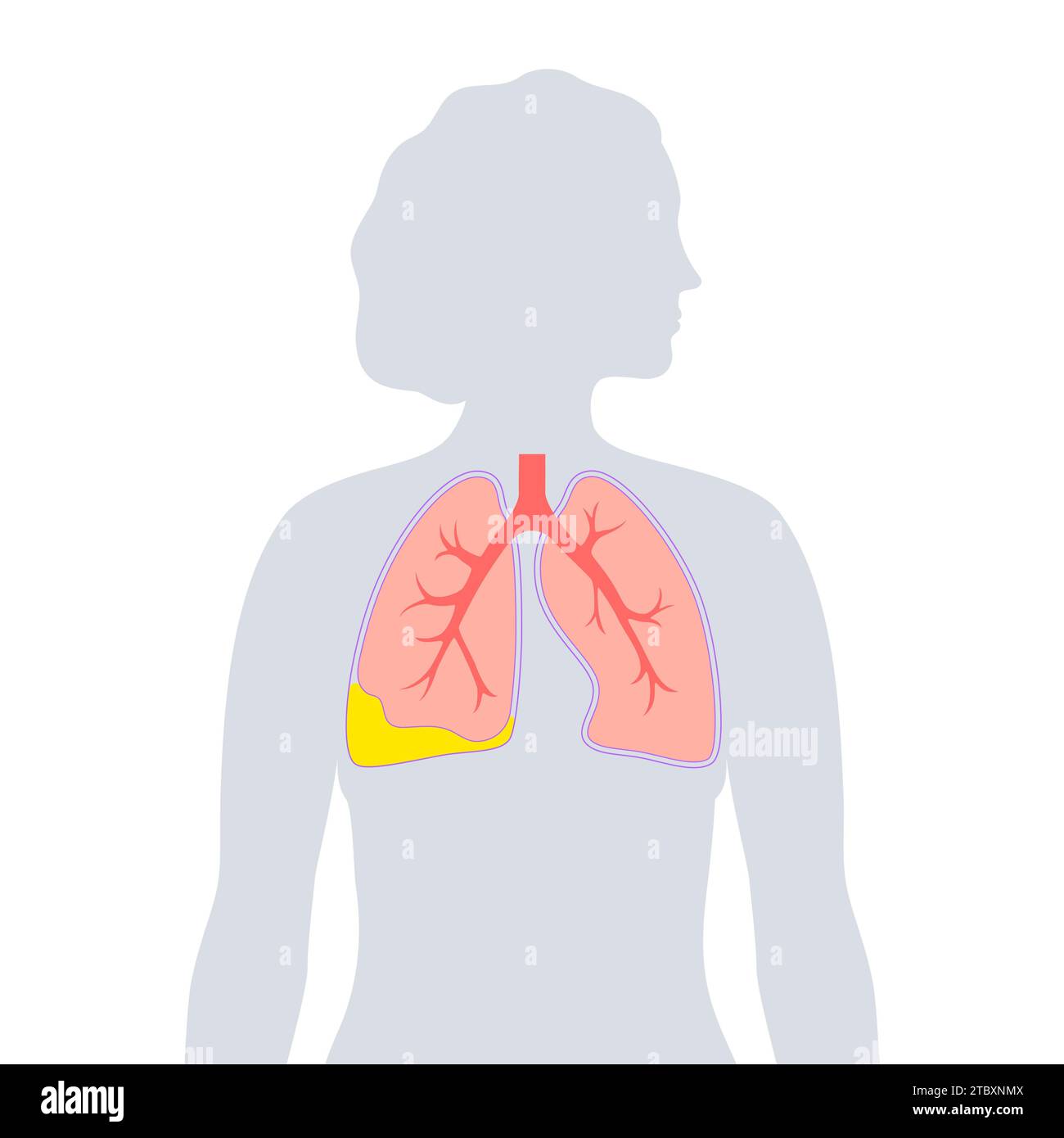 Pyothorax hi-res stock photography and images - Alamy