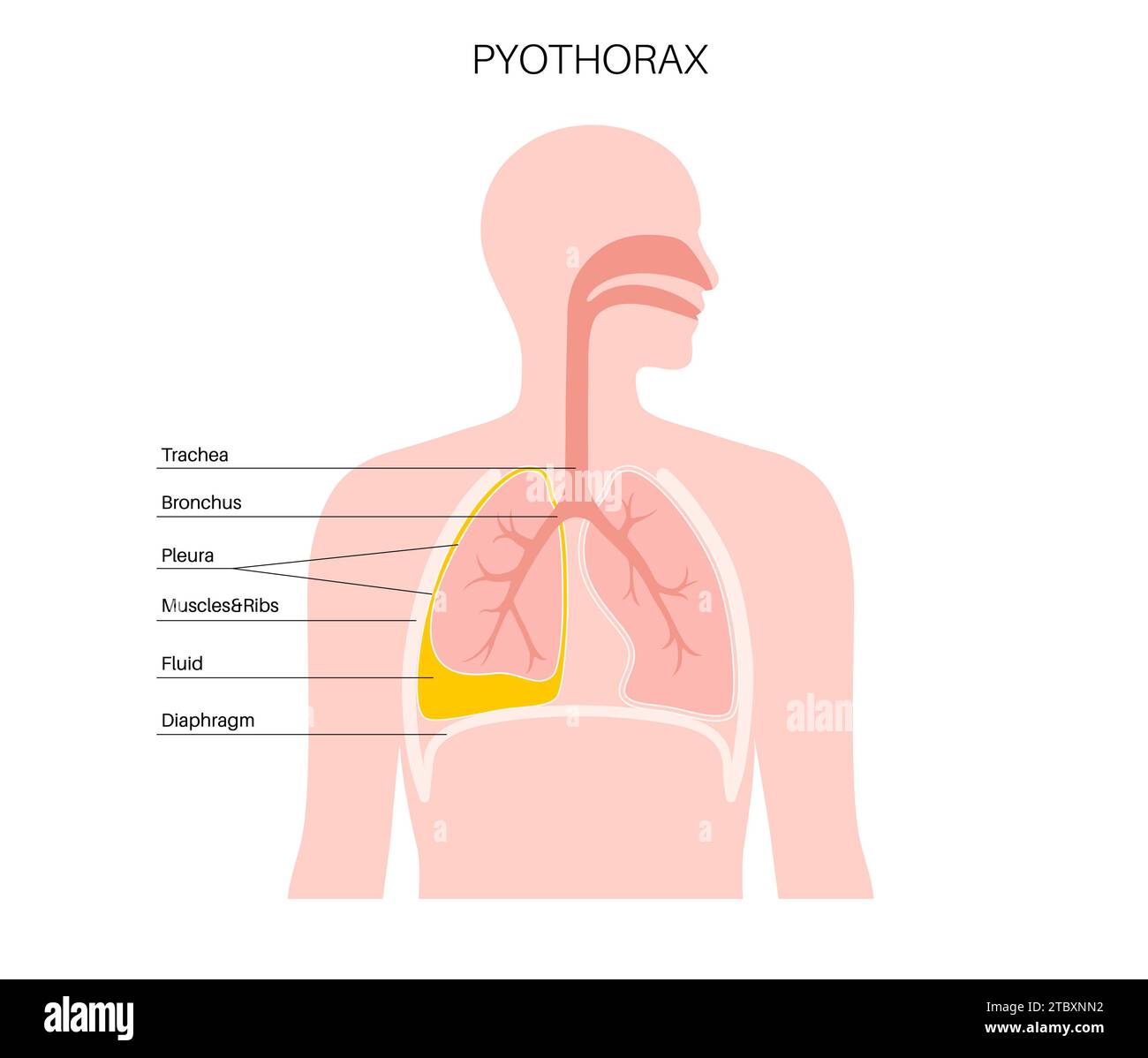 Pyothorax hi-res stock photography and images - Alamy