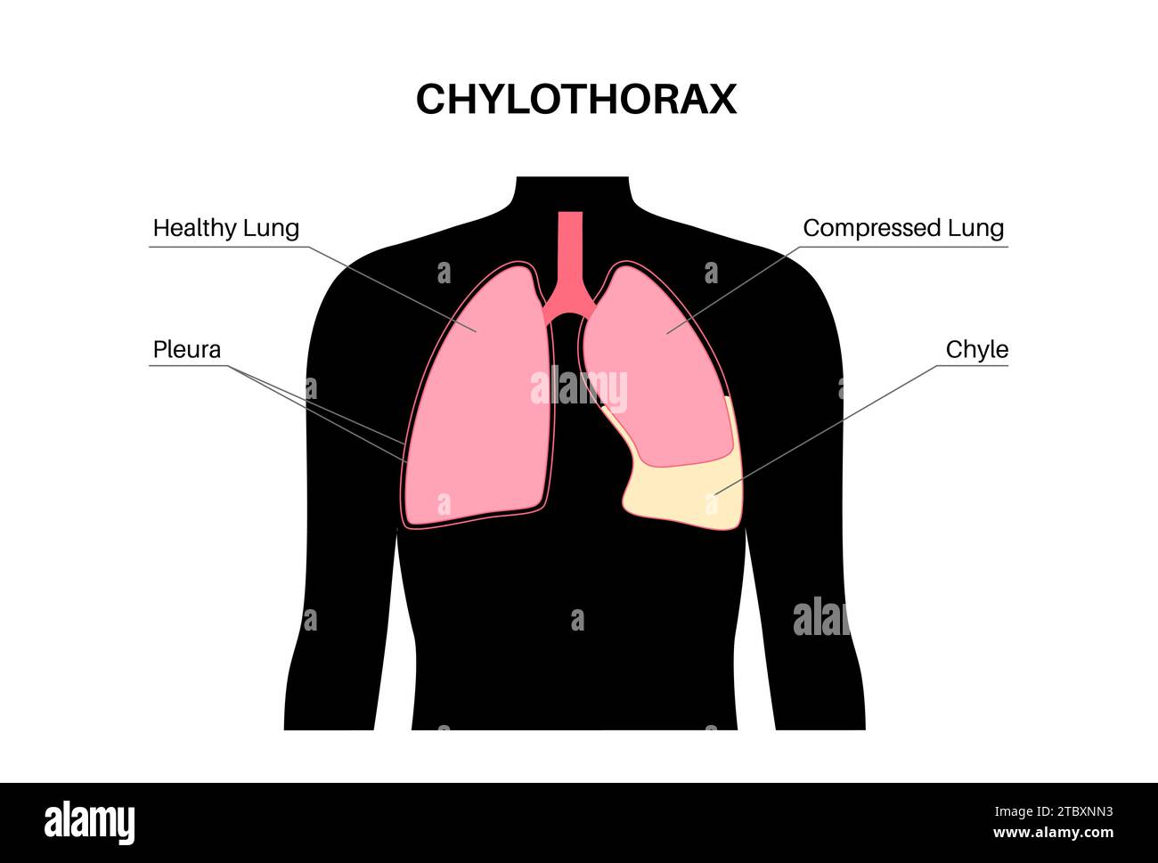 Chylothorax hi-res stock photography and images - Alamy