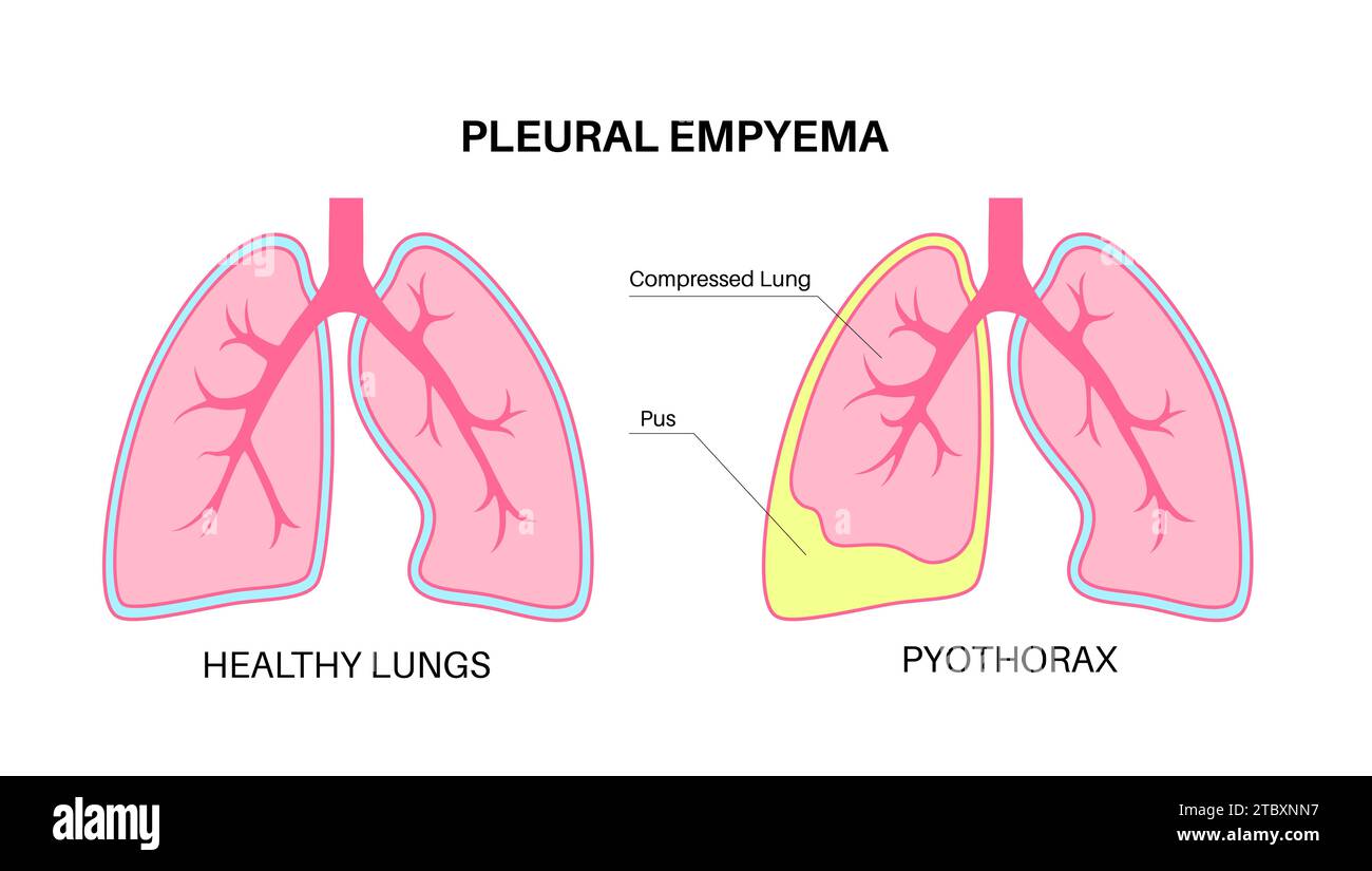 Pyothorax hi-res stock photography and images - Alamy