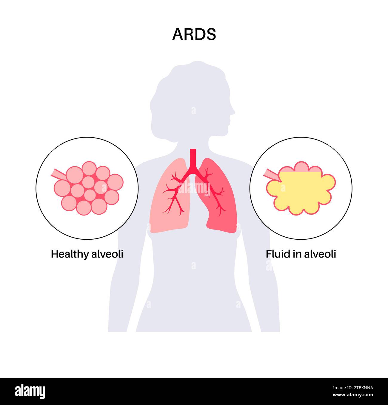 Acute respiratory distress, illustration Stock Photo - Alamy