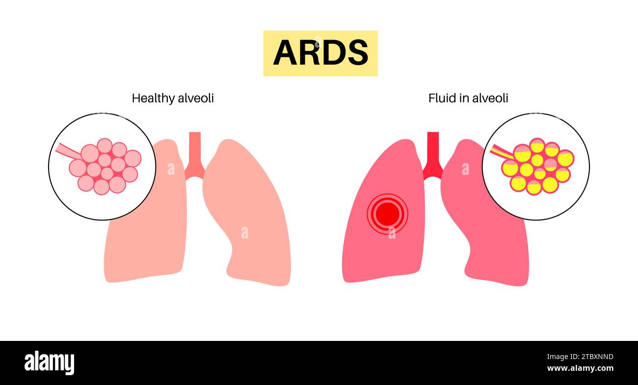 Acute respiratory distress (ARDS), illustration Stock Photo - Alamy