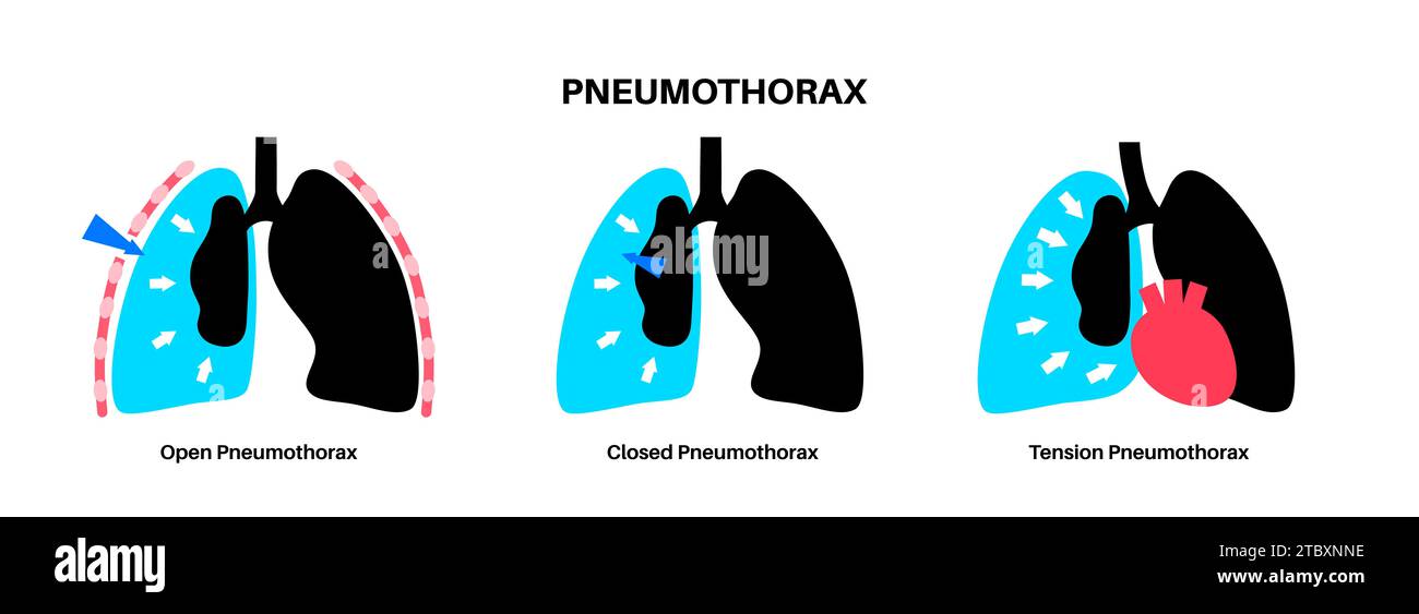 Pneumothorax collapsed lung hi-res stock photography and images - Alamy