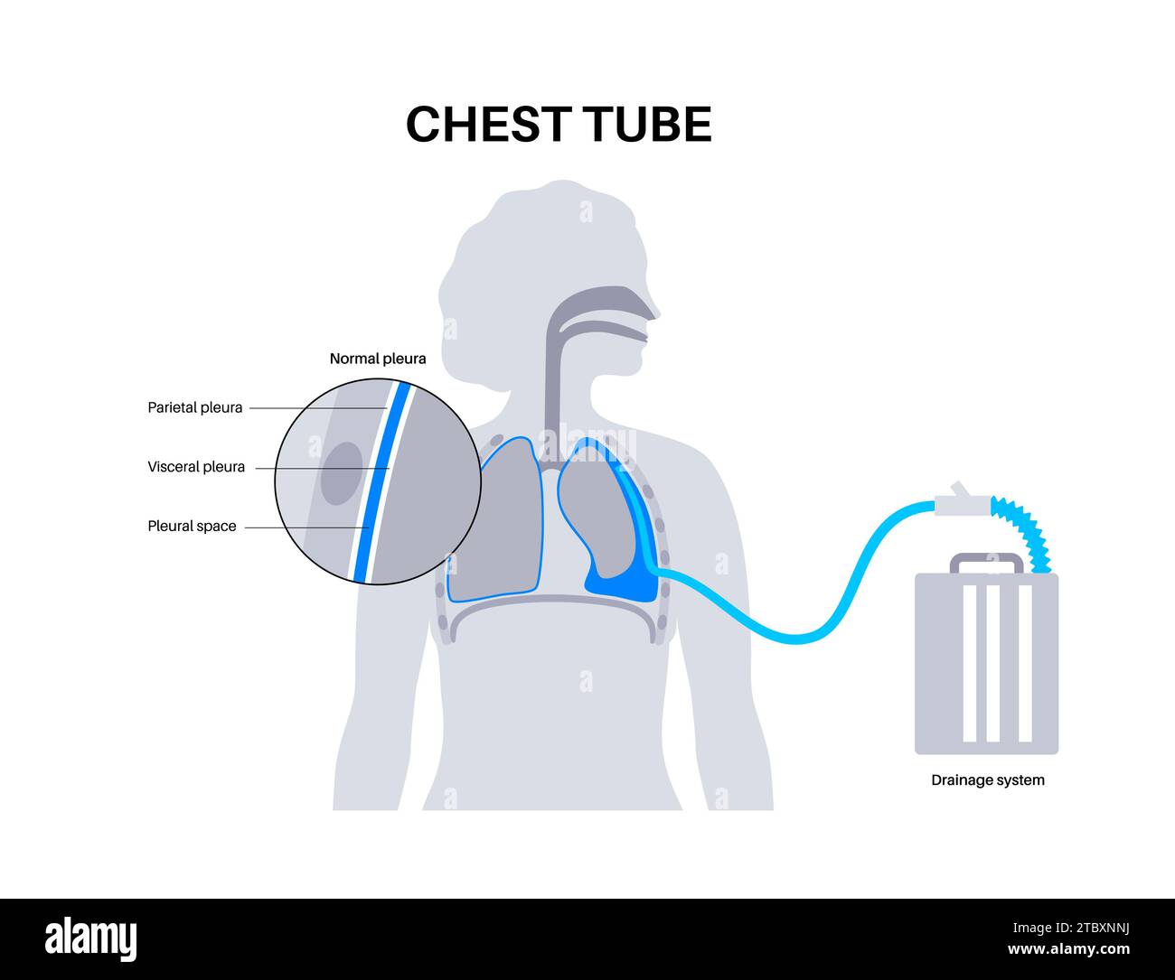 Low Pressure Chest Tube at Molly Carmichael blog
