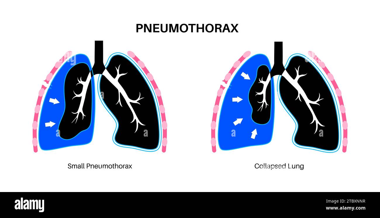 Pneumothorax collapsed lung hi-res stock photography and images - Alamy