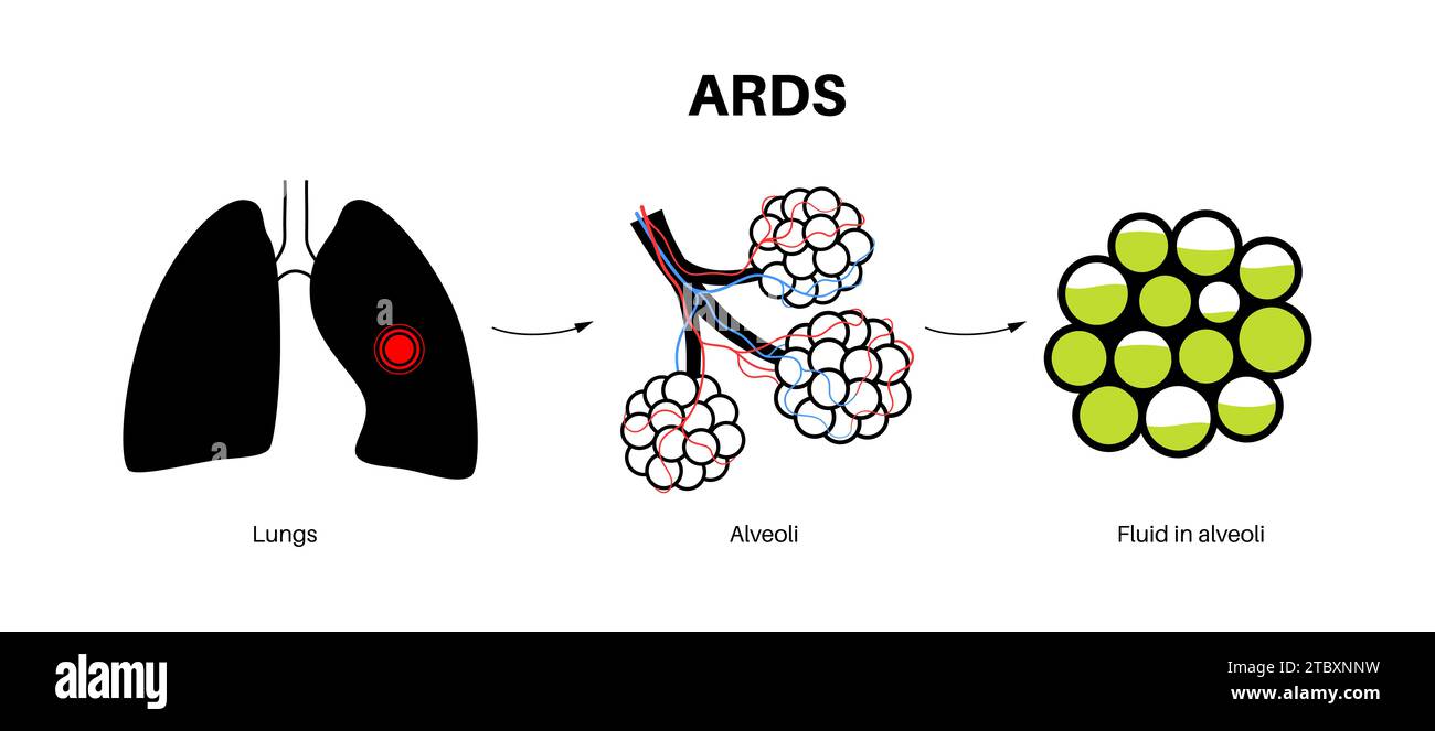 Acute respiratory distress, illustration Stock Photo - Alamy
