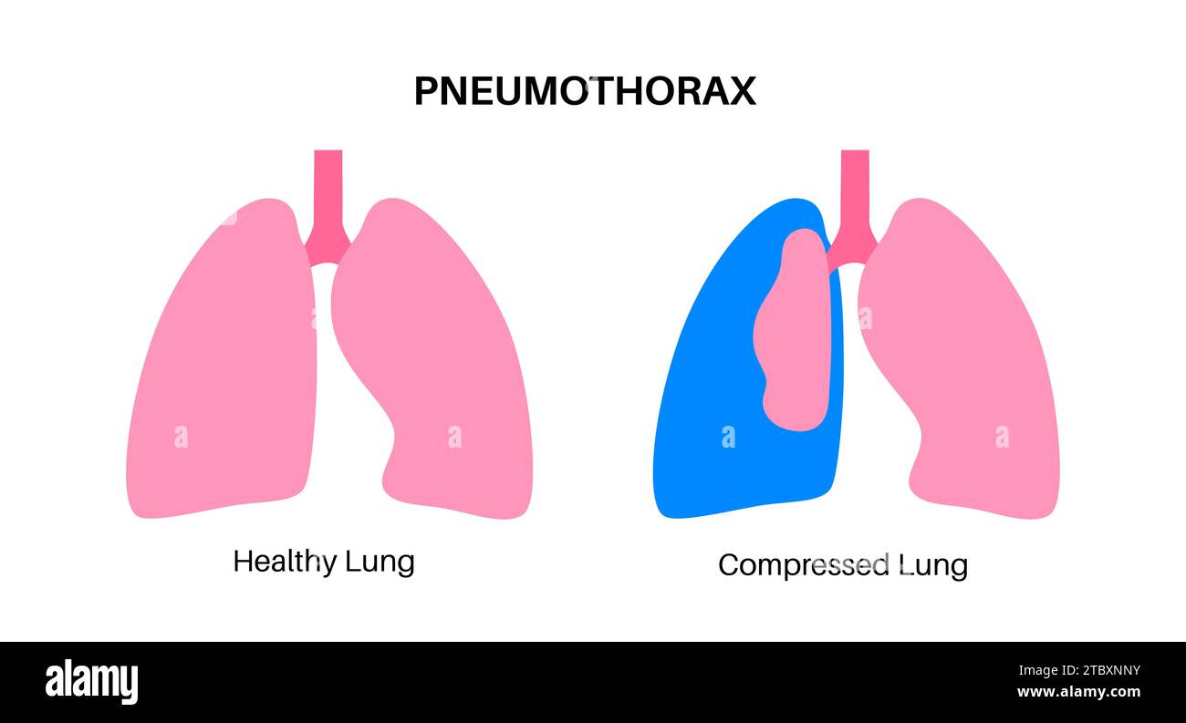 Pneumothorax collapsed lung hi-res stock photography and images - Alamy