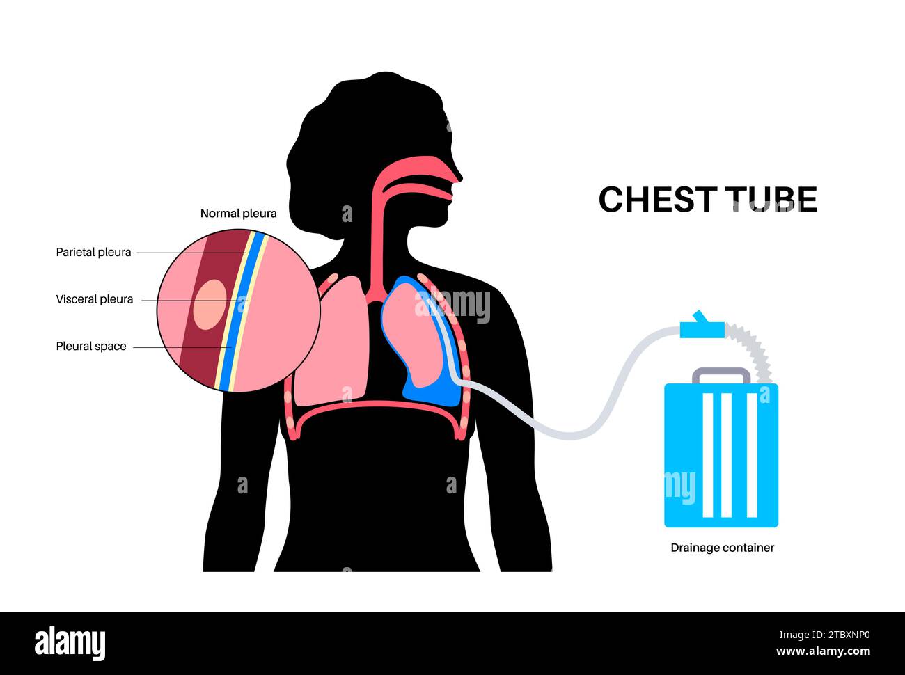 Chest tube catheter, illustration Stock Photo - Alamy
