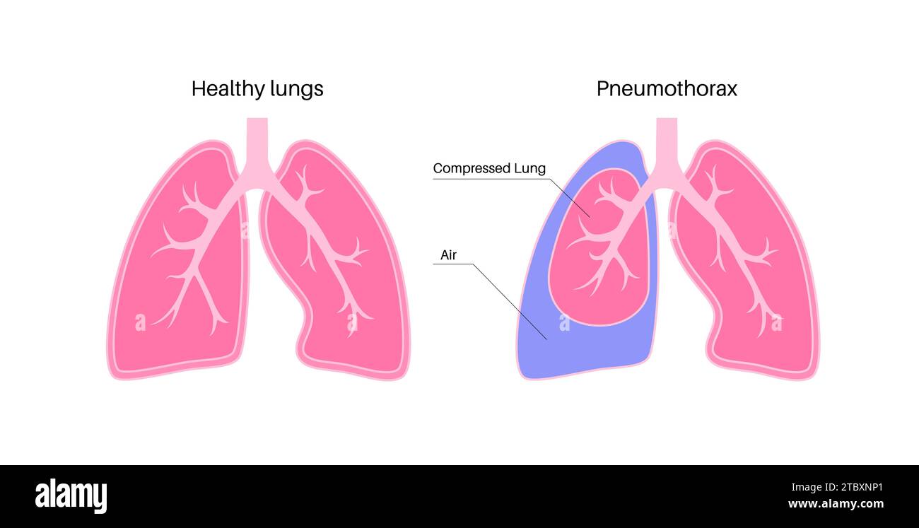 Pneumothorax collapsed lung hi-res stock photography and images - Alamy