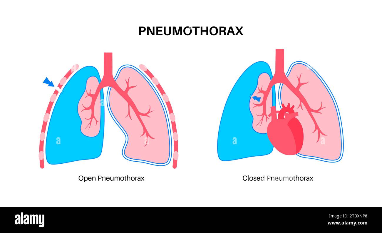 Pneumothorax collapsed lung hi-res stock photography and images - Alamy