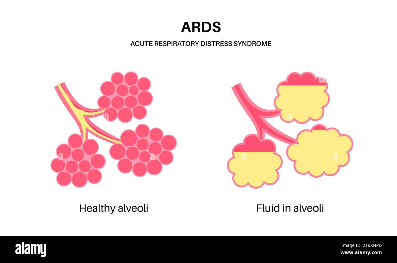 Acute respiratory distress, illustration Stock Photo - Alamy