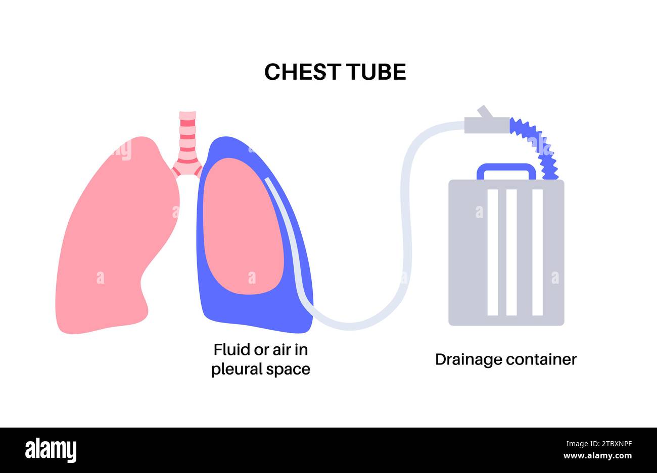 Chest tube catheter, illustration Stock Photo - Alamy